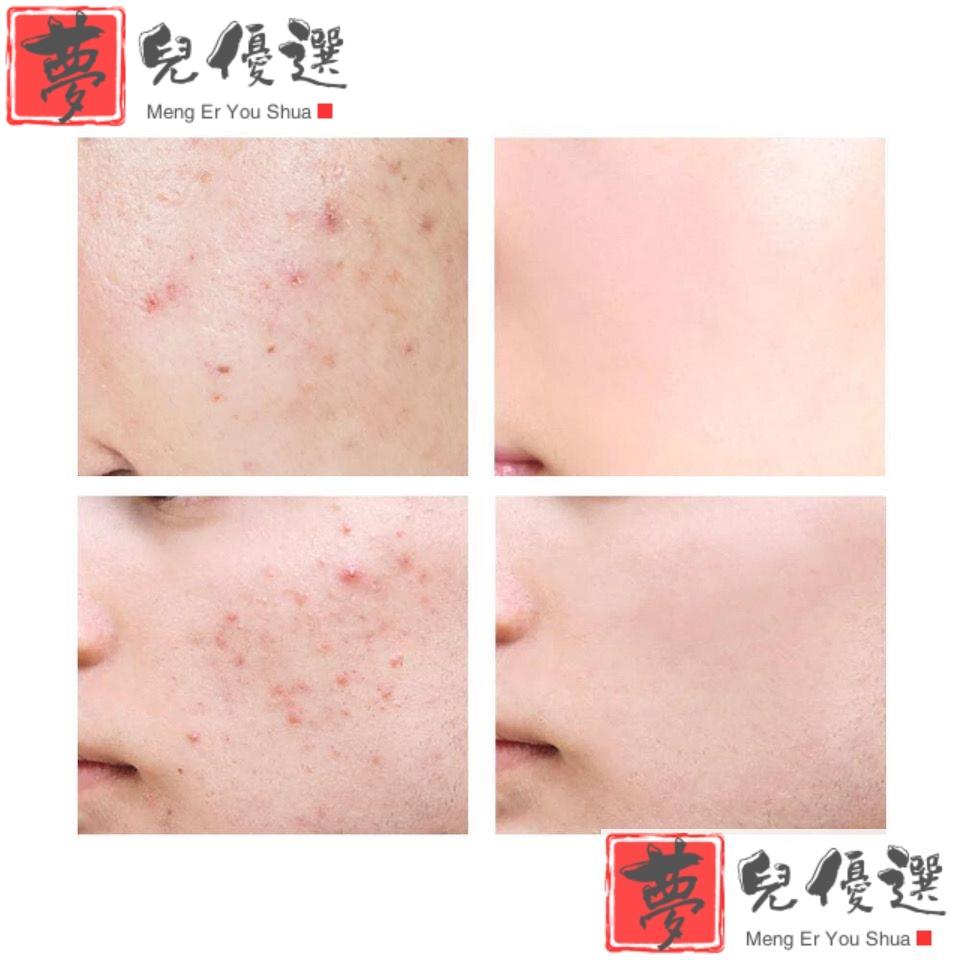Acne Scar Removal Gel Fade Marks Spots Remove Skin Pigmentat | 蝦皮購物