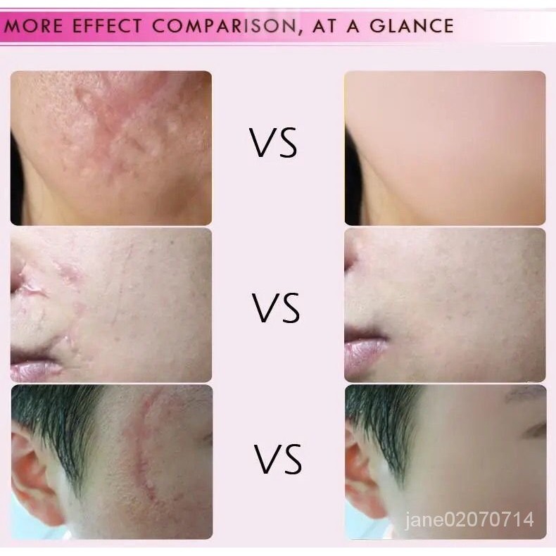 Acne Scar Stretch Marks Remover Face Cream Skin Repair | 蝦皮購物