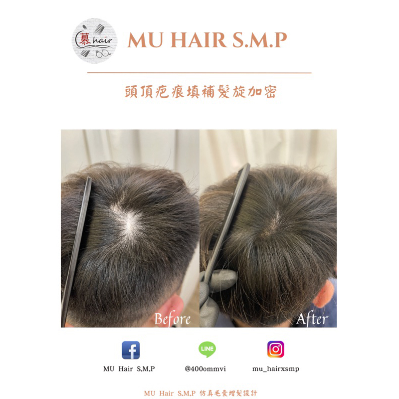 Mu hair SMP 仿真毛囊增髮設計 頭皮刺青 紋繡 落髮 掉髮 壓力禿 鬼剃頭 產後落髮 雄性禿 | 蝦皮購物