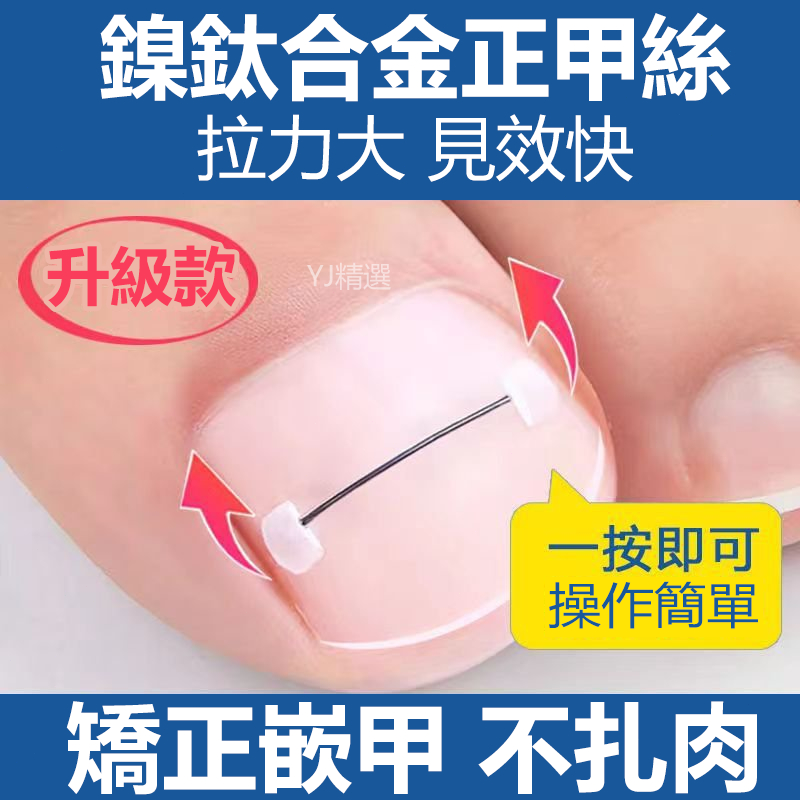 🔥臺灣出貨48H🔥甲溝嵌甲鎳鈦閤金絲記憶鋼絲腳趾甲指甲紮肉墊甲貼片甲墊hhfoof | 蝦皮購物